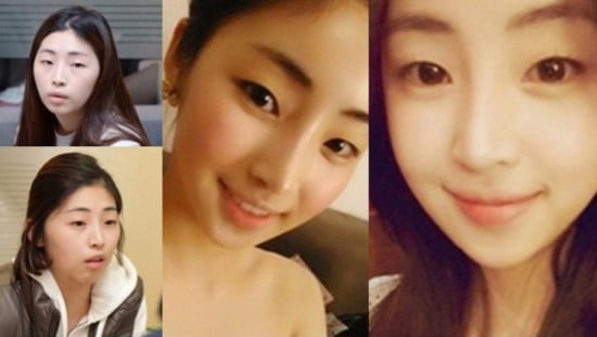 Plastic Surgery Before And After Korean Twins